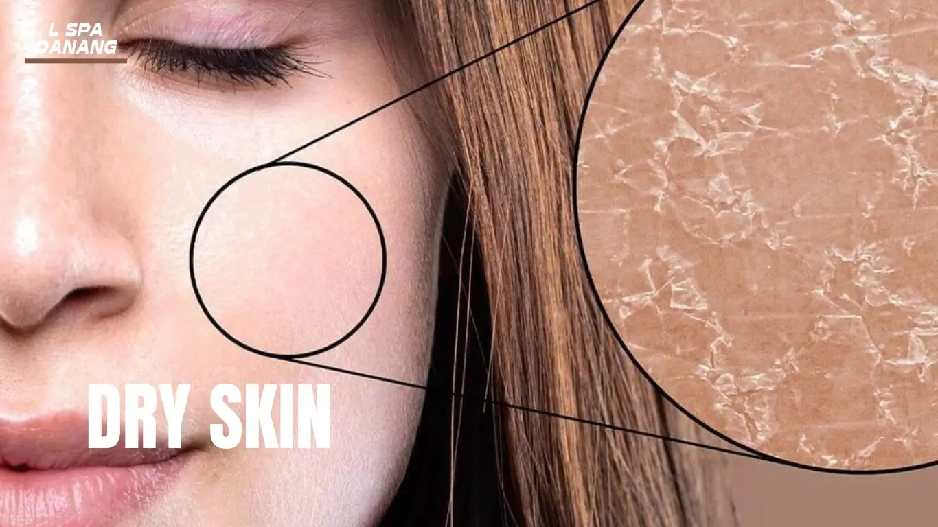 Dry Skin: Types, Risk Factors, Treatments and more - L Spa Da Nang